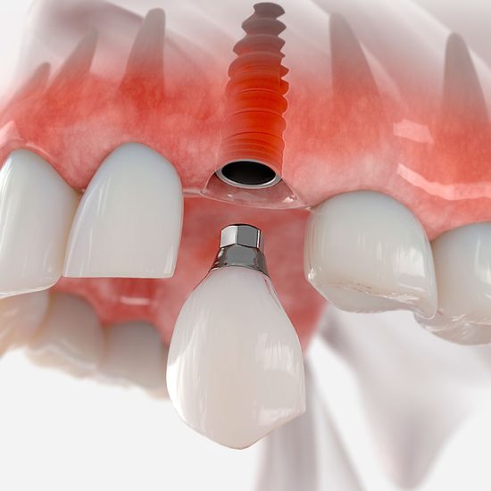 Implantes osteointegrados – Clínica Dental Nova Sur de Mislata